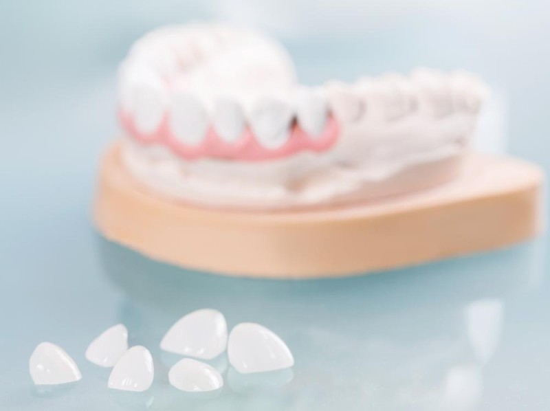 Kompozitne fasete - Ordinacija Cvejanović