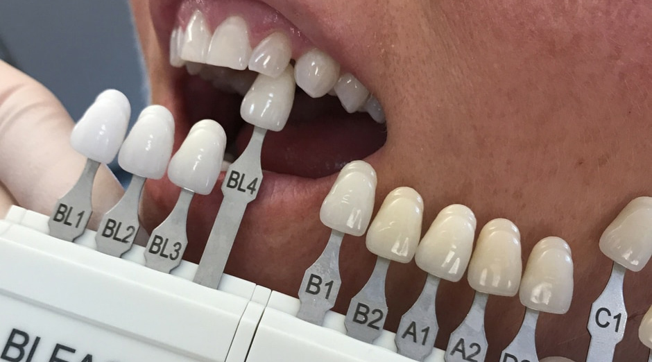 Tooth Crown Color Chart Tooth Crown Color Chart